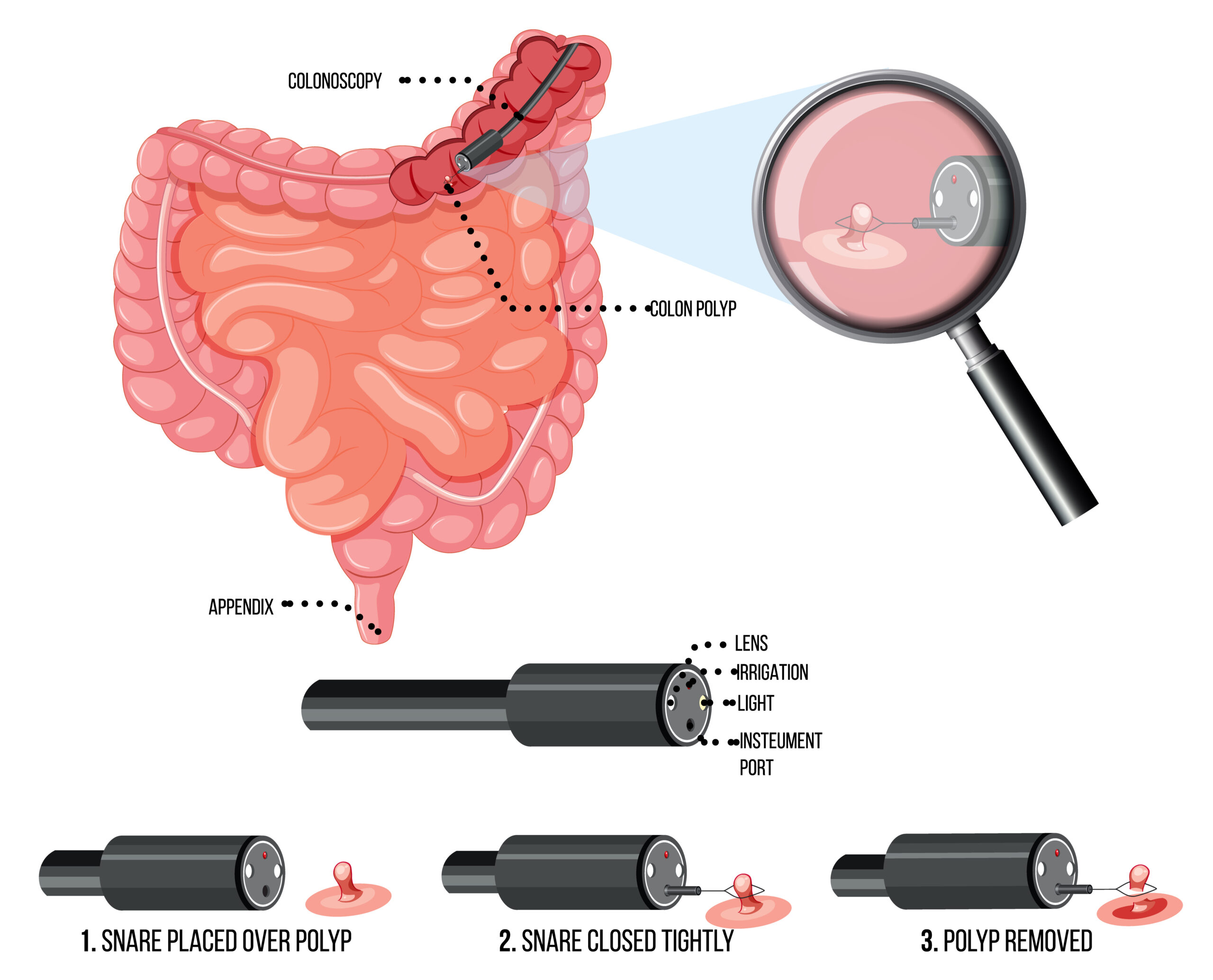 Endoscopy - Dr Rachit Agarwal